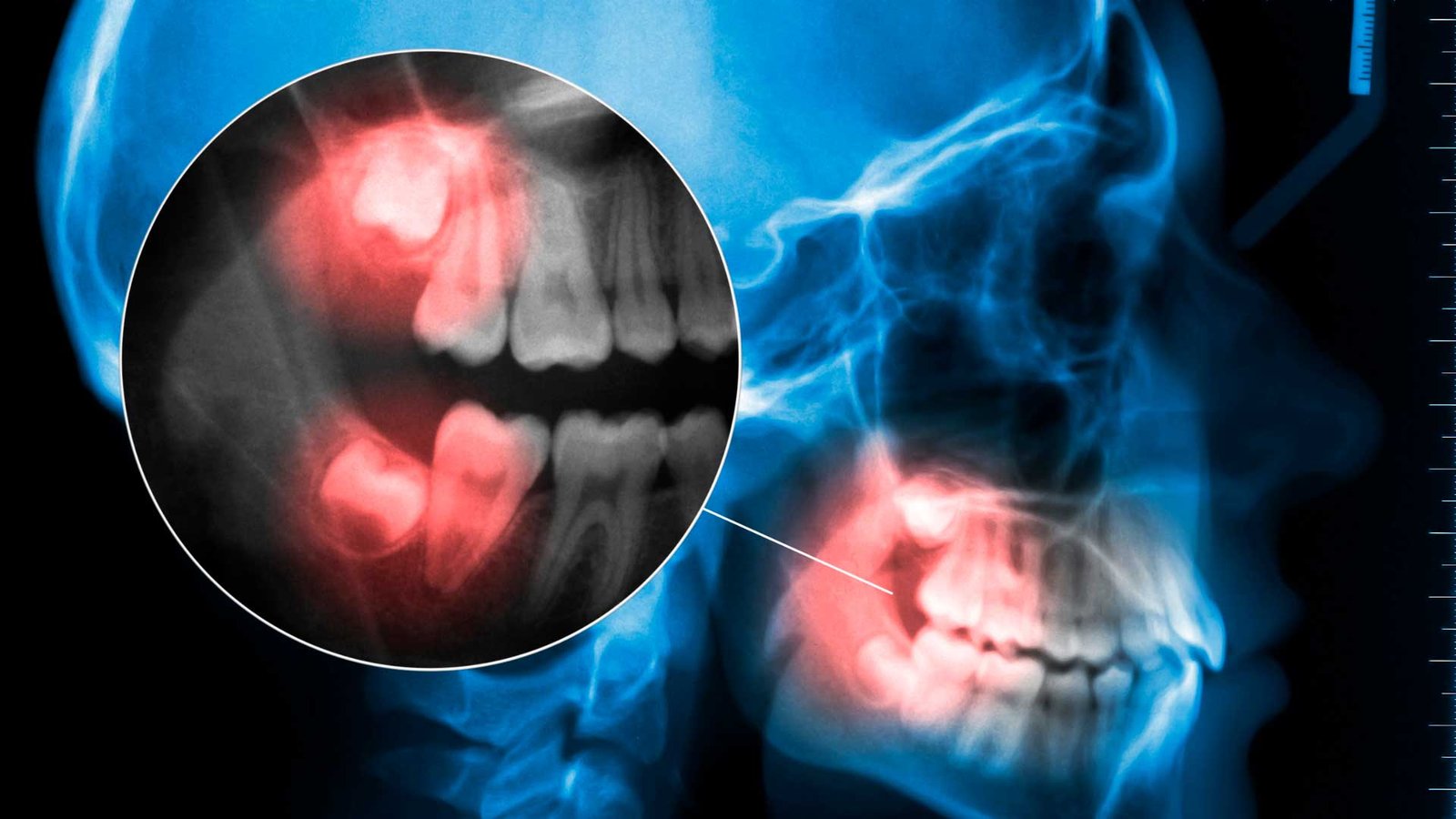 Muelas del Juicio - Lael Dental